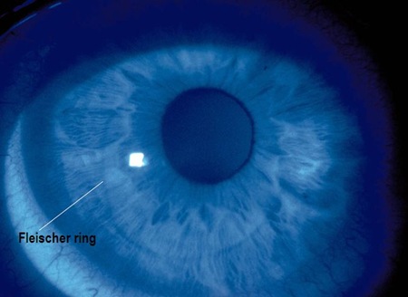 Medicine Decoded: Corneal Pigmentation – Decoded